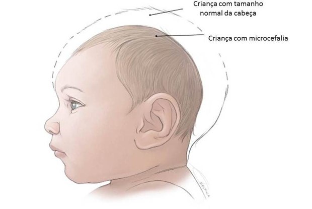 GEOGRAFIA EM FOCO: Epidemia da Febre Zica versus Surto de Microcefalia ...