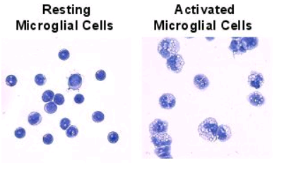 Epiphany: Activated Microglia and Inflammation in Autism