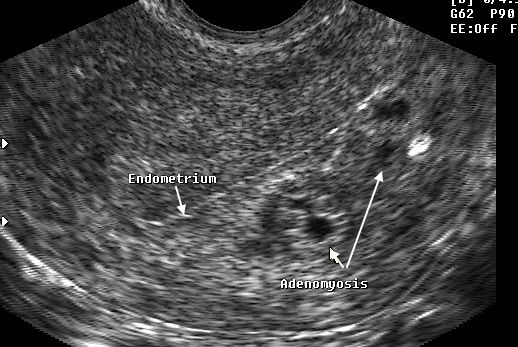 MEDICAL ULTRASOUND/ADENOMYOSIS