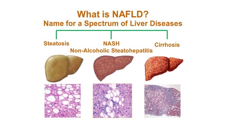 Non Alcoholic Fatty Liver Disease - Causes, Symptoms and Treatments