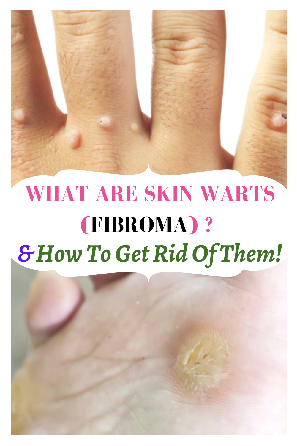 What Are Skin Warts (Fibroma) And How To Get Rid Of Them!