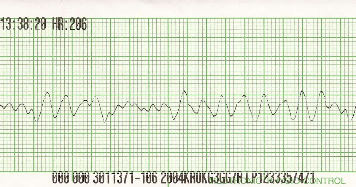 EKG Rhythm Strip Quiz 6