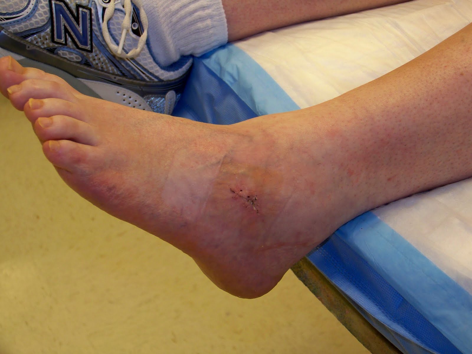 My posterior tibial tendon surgery journey