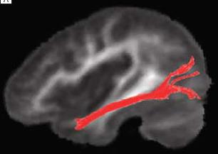 inferior longitudinal fasciculus - meddic