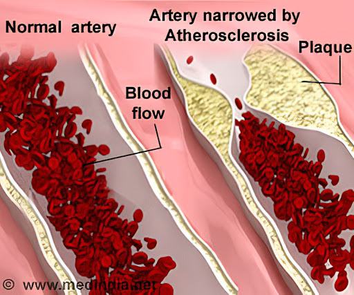 atherosclerosis