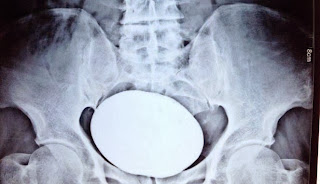 This Man Had A Largest Kidney Stone In The World | Health and Safety