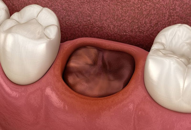 PDF: Recent advances in the management of Dry Socket - A review