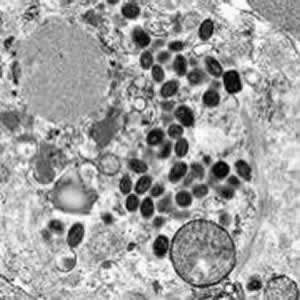 Medical Treatment Pictures-for Better Understanding: Smallpox Disease