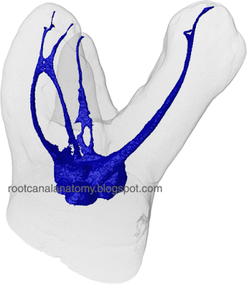 The Root Canal Anatomy Project: MB2 Canal [Maxillary First Molar]