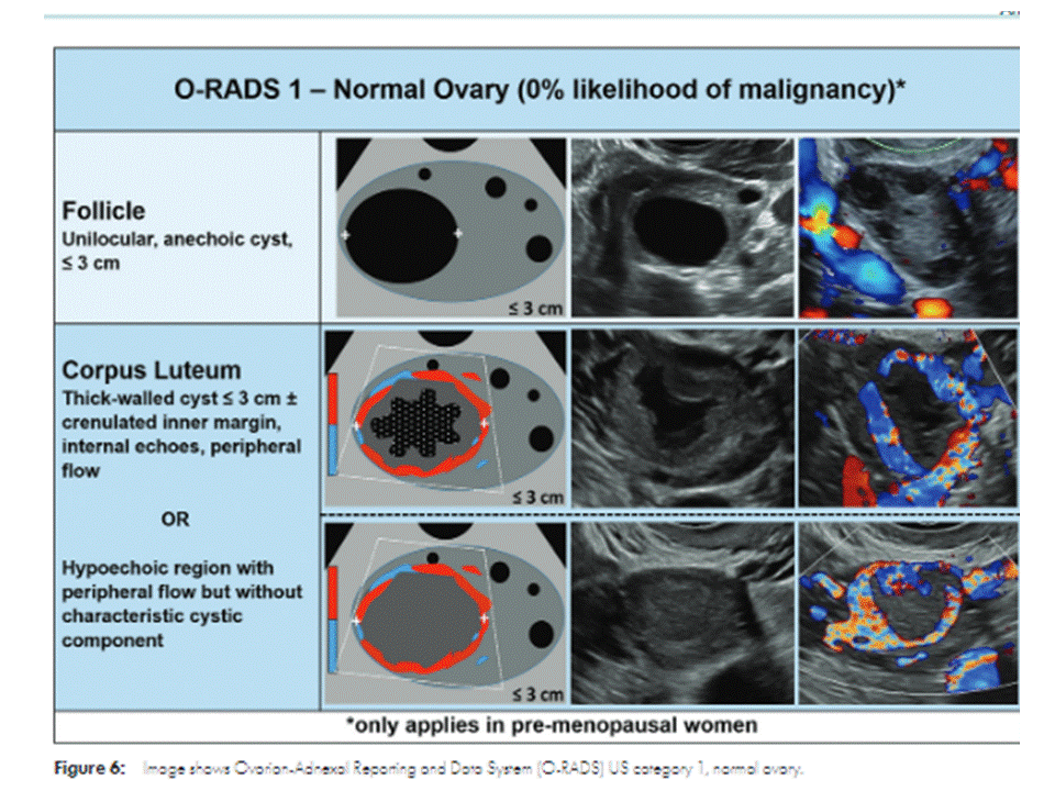 BÀI SOẠN VỀ SIÊU ÂM CHẨN ĐOÁN: O-RADS US