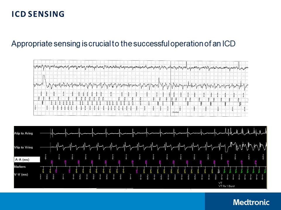 CVT Mohd Farid: Concept Of ICD Technology-Sensing & Detection-Medtronic ...