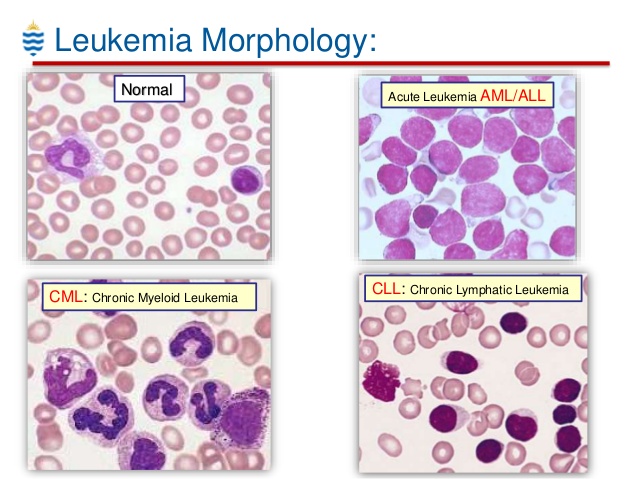 Tanda Awal Kanser Leukimia Dan Cara Rawatannya ~ Cara Hidup Sihat
