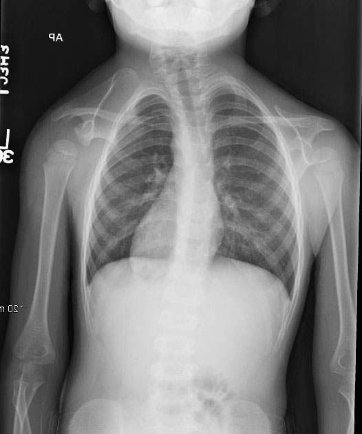 Sprengel Deformity | Congenital Hand and Arm Differences | Washington ...