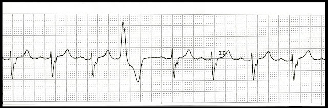 Practice EKG Rhythm Strips 155