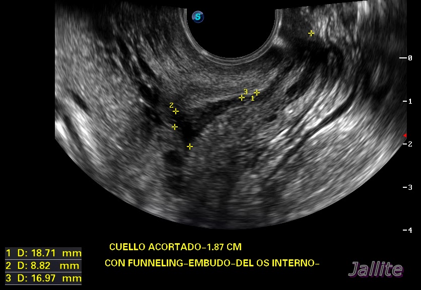 La Cervicometría con Elastografia en la Amenaza de Parto Prematuro