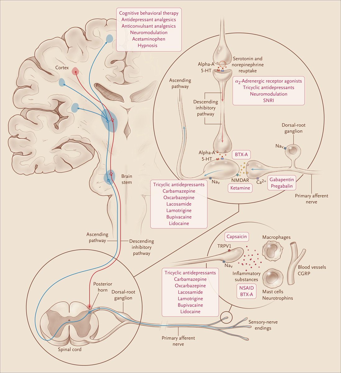 ZONA DE SALUD DE OFRA: (NEJM) Abordaje del DCNO sin opioides.