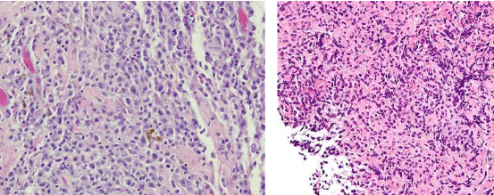 lymphoma cancer | Lymphoma