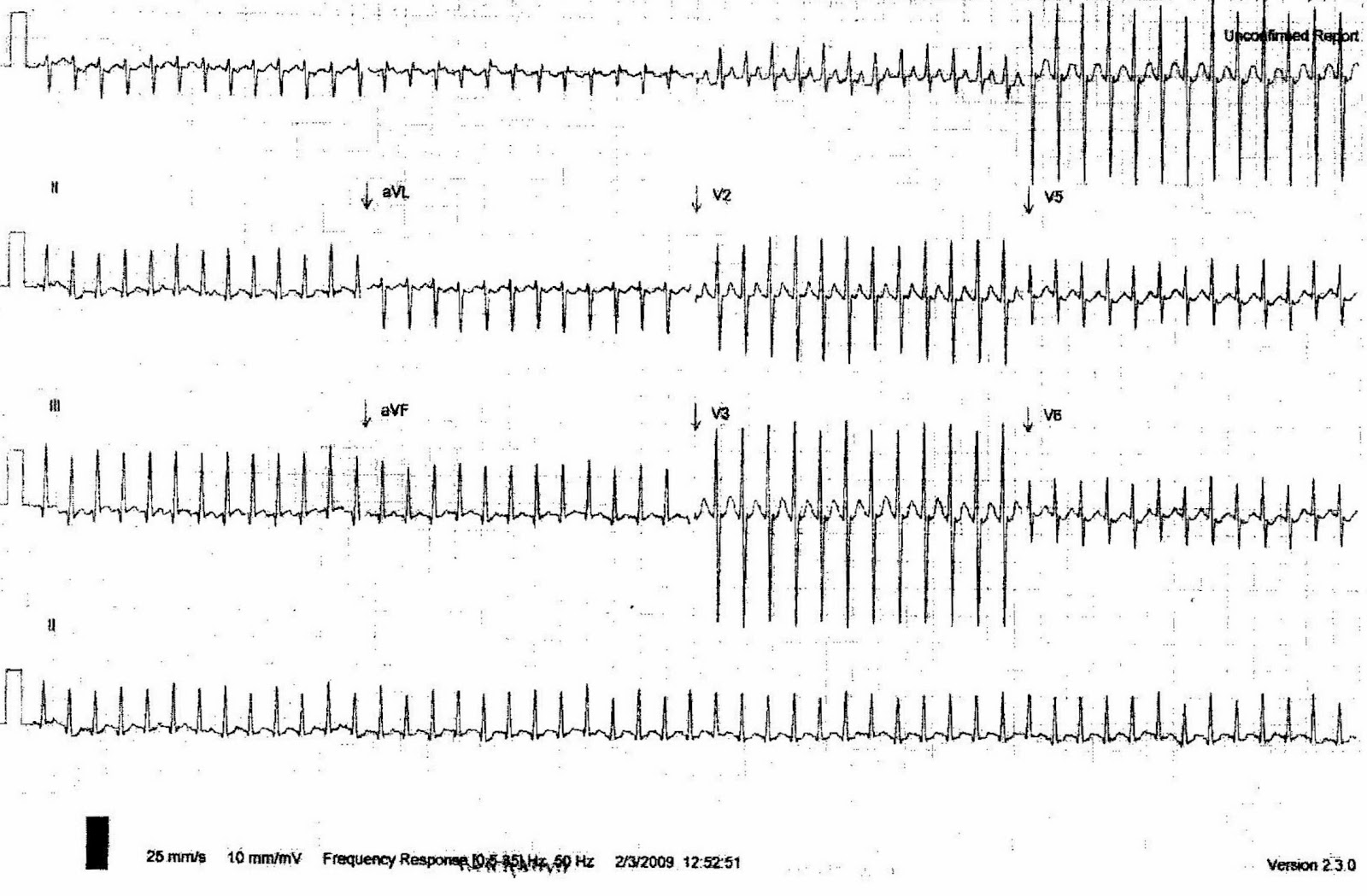 Acute Care: Ecg In Emergency Medicine And Acute Care
