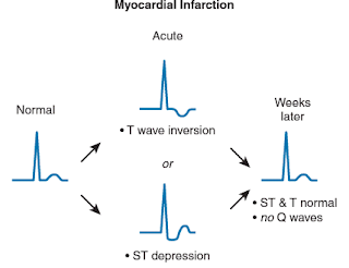 Infark Miocard Akut - askep