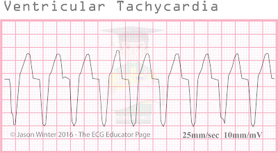 ECG Educator Blog : Ventricular Rhythms
