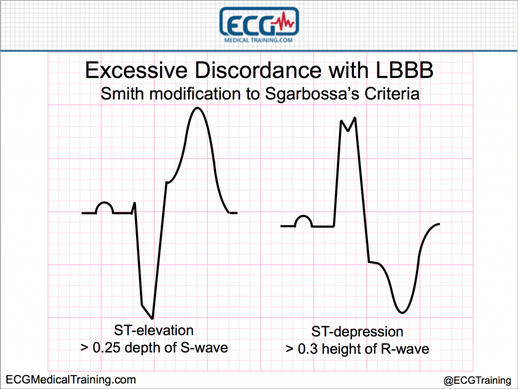 Bác Sĩ Gấu: BLOCK NHÁNH TRÁI (LBBB) VÀ STEMI