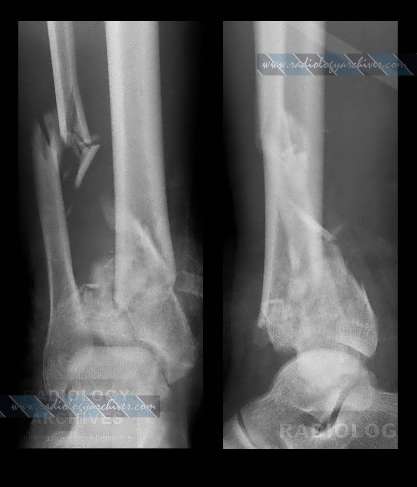 Radiology Archives: Κάταγμα Pilon* (Πολυτμηματικό Ενδοαρθρικό Κάταγμα ...