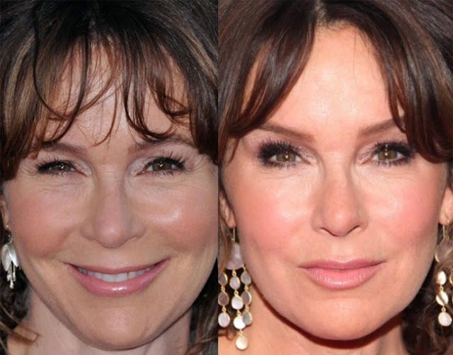 Jennifer Grey Nose Job Before and After | Celebrity Bad Plastics Surgery