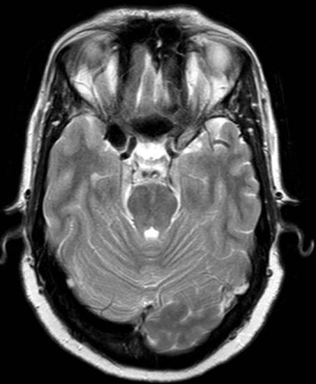 Onodi Cell-Mistaken as ICA Aneurysm - Sumer's Radiology Blog