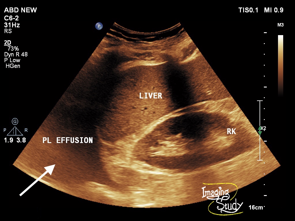 Case 16 Pleural Effusion Ultrasound