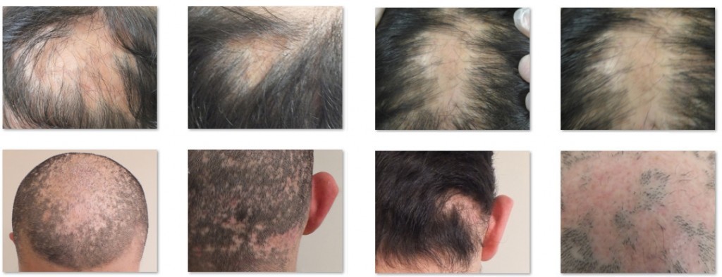 Alopecia ( Hair loss) types, causes and effects in men and woman or ...