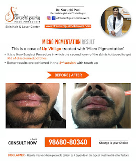 Lip Vitiligo Treatment with Micro Pigmentation | Best Skin Specialist ...