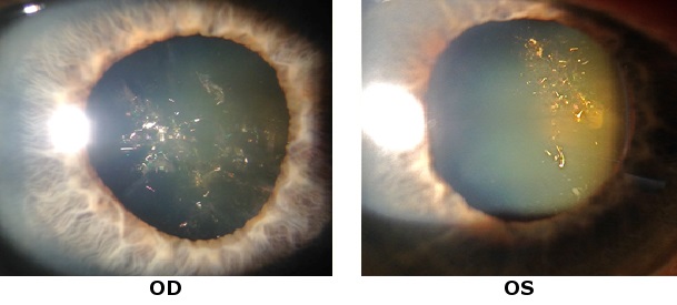 Ophthalmology Notes: Types of Cataract associated with Systemic Conditions