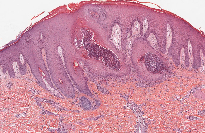 Differential Diagnosis in Dermatopathology: 2014