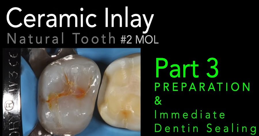 CLINICAL CASE: Ceramic Inlay, Part 3 (Preparation and IDS) - Odonto-Tv