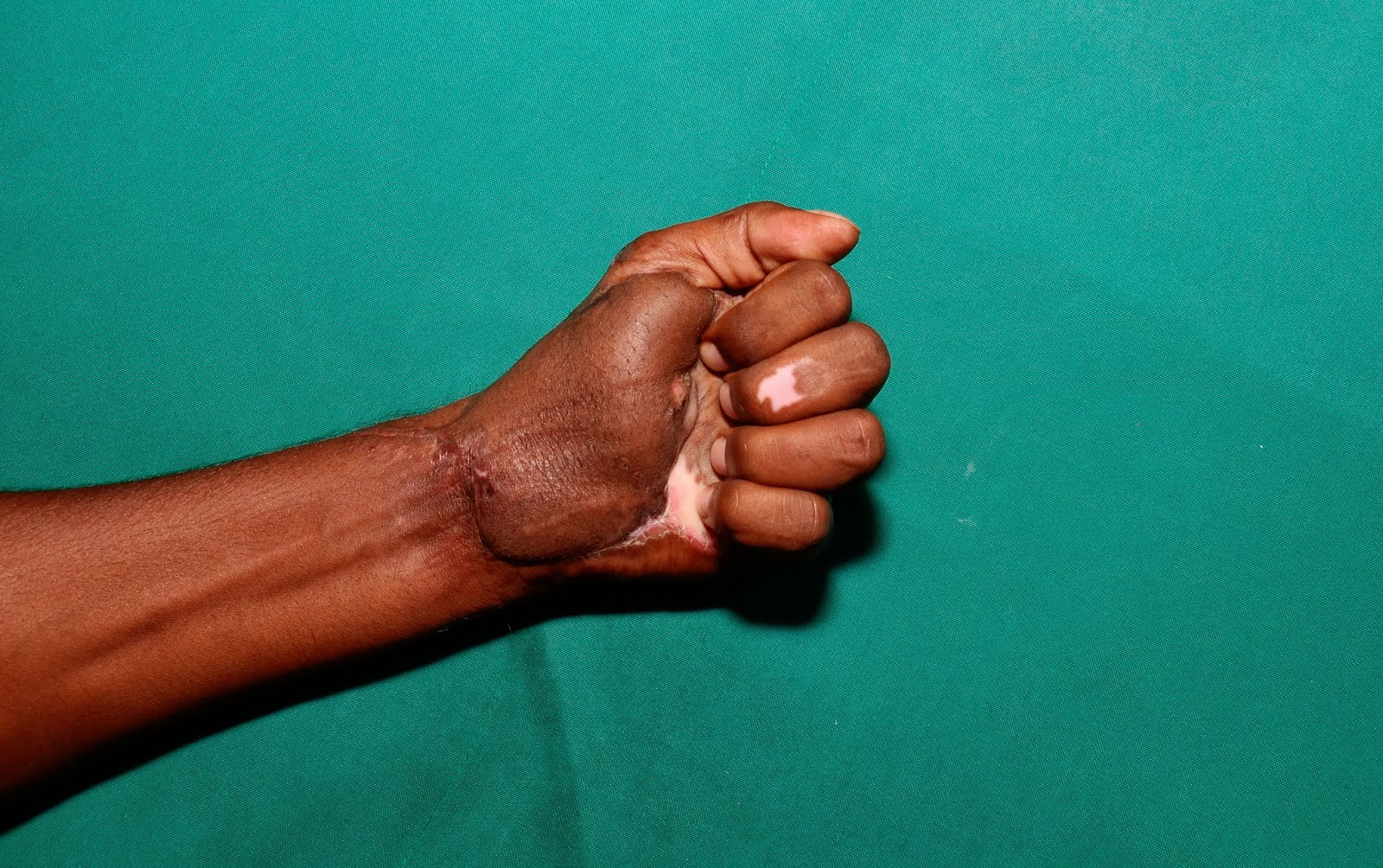 CRUSH INJURIES OF HAND AND UPPER LIMB INJURIES: PALMAR DEGLOVING INJURY ...