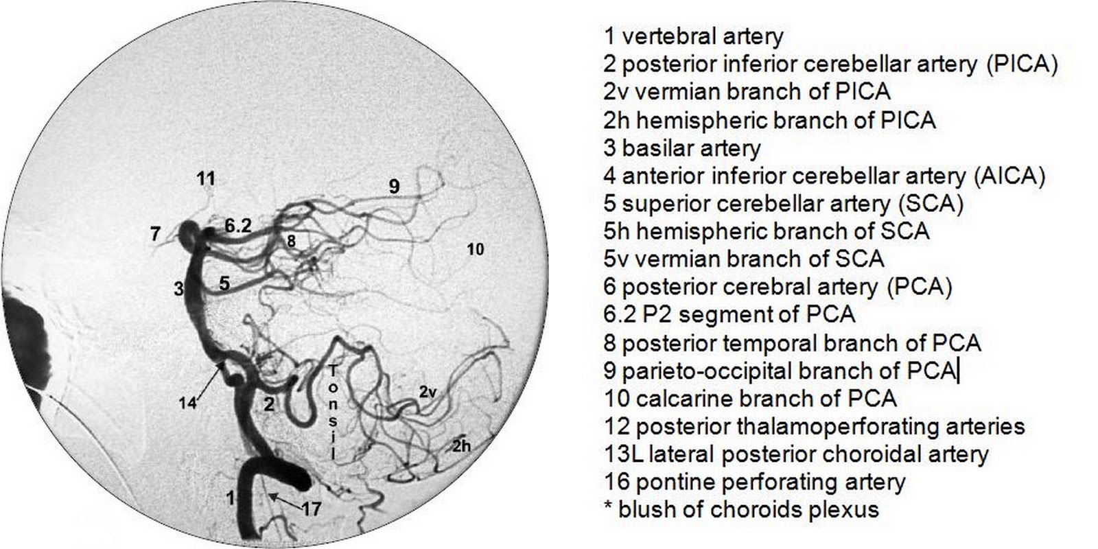 Dr Balaji Anvekar FRCR: Normal Brain Angiogram DSA