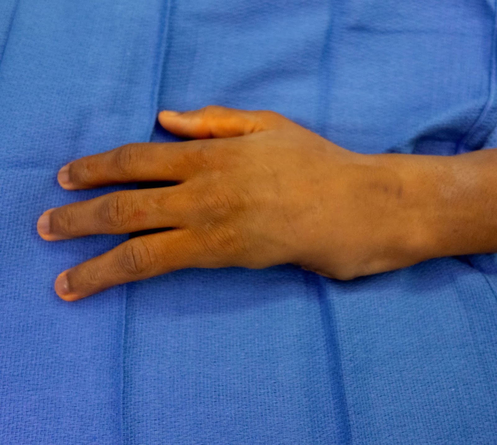 Not the typical hand deficiency- ulnar cleft hand | Congenital Hand and ...