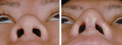 Alar Base Reduction - Reduce nose wings