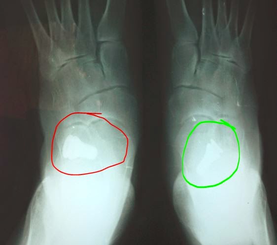 HyProCure Surgery: Days 10 - 14
