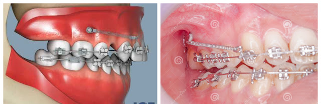 Screw souvenir after jaw surgery months ago. Was very loose so I took ...