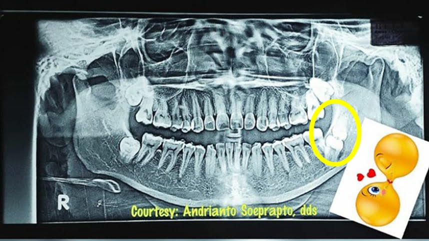 Tips Atasi Gigi Impaksi, Syarat Baru Tes Gigi Angkatan Darat, Laut Dan ...