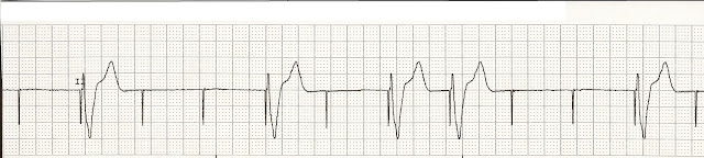 EKG Rhythm Strip Quiz 56: Paced Rhythms