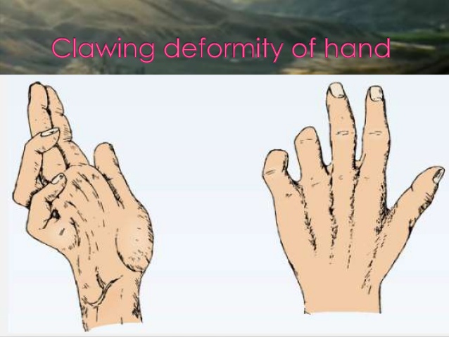 SAMARPAN PHYSIOTHERAPY CLINIC: ULNER NERVE INJURY AND PHYSIOTHERAPY TREATMENT