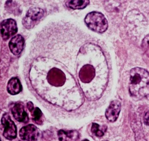 PATHOGNOMONIC SIGNS PART 2 | notes.nursium.com