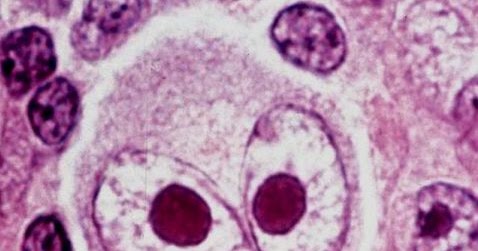PATHOGNOMONIC SIGNS PART 2 | notes.nursium.com