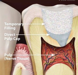 Pulp Capping