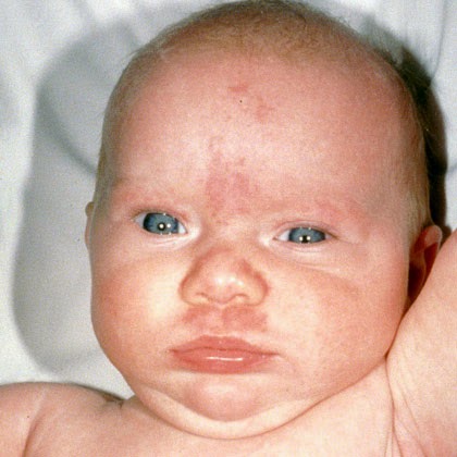 new mum and new baby: Spots and freckles skin in newborns