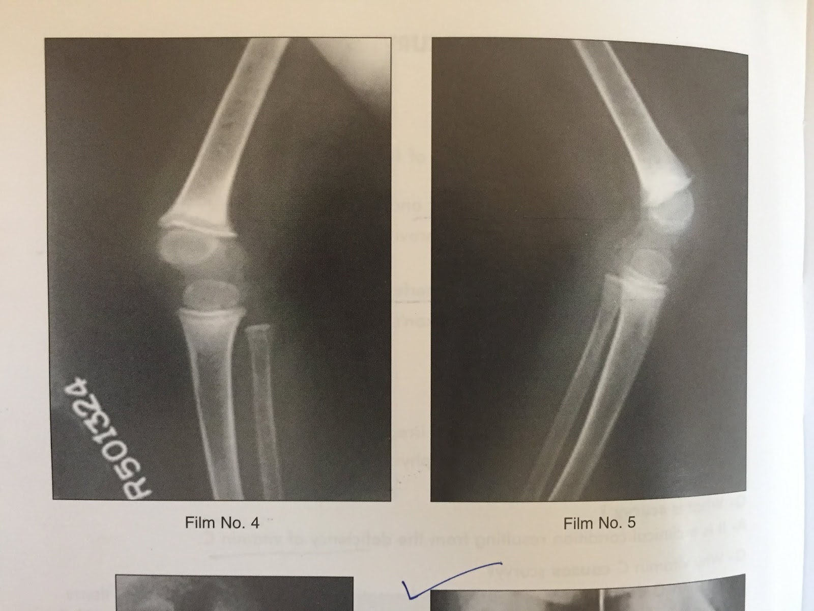 XRAY OF SCURVY DISEASE