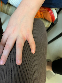 Recurrent Syndactyly | Congenital Hand and Arm Differences | Washington ...