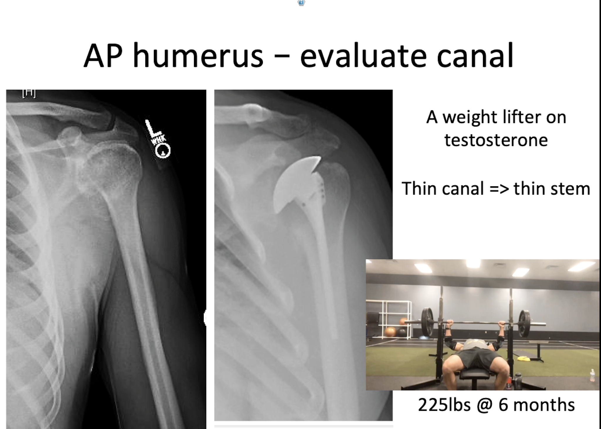 UW Shoulder and Elbow Academy: Ream and run - imaging the shoulder ...